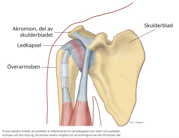 Frusen skuldra, frusen axel, frozen shoulder | Ett nytt liv...